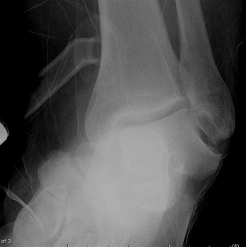 Subtalar Dislocations - Trauma - Orthobullets